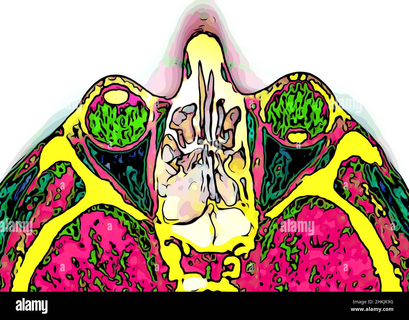 Traumatic detachment of the lens of the eye, CT scan Stock Photo - Alamy
