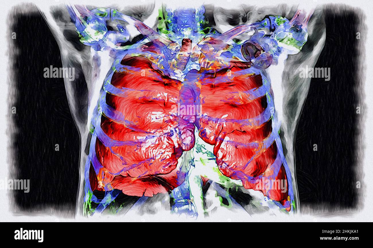 Lungs and ribs, CT scan Stock Photo - Alamy