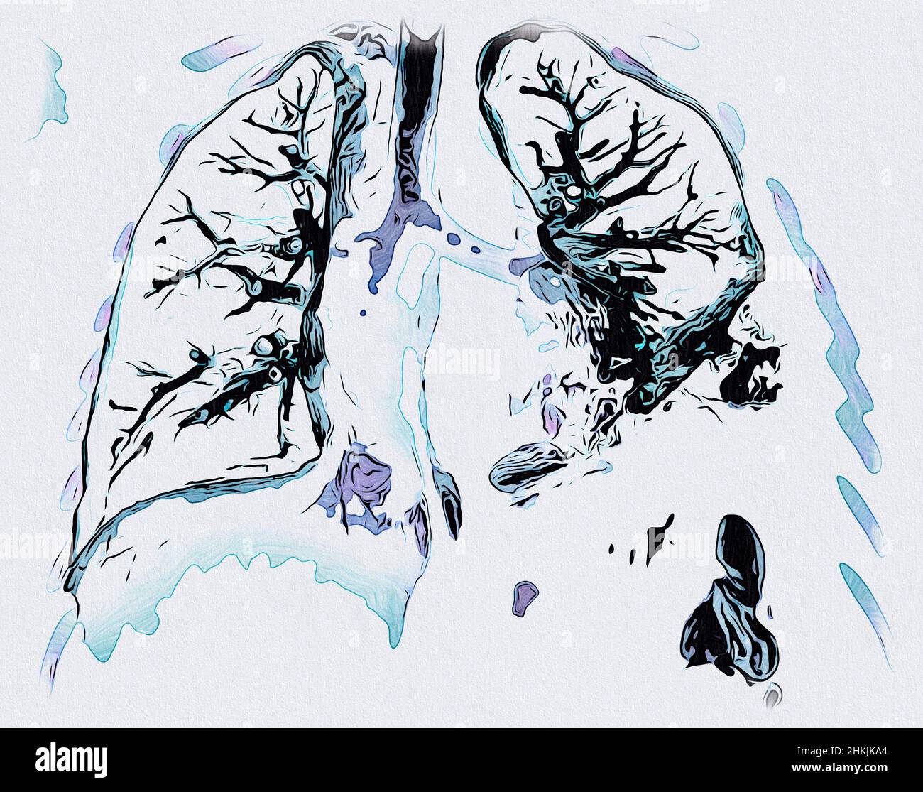 Lung affected by pneumonia, CT scan Stock Photo - Alamy