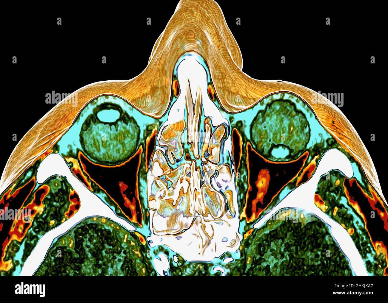 Traumatic detachment of the lens of the eye, CT scan Stock Photo - Alamy