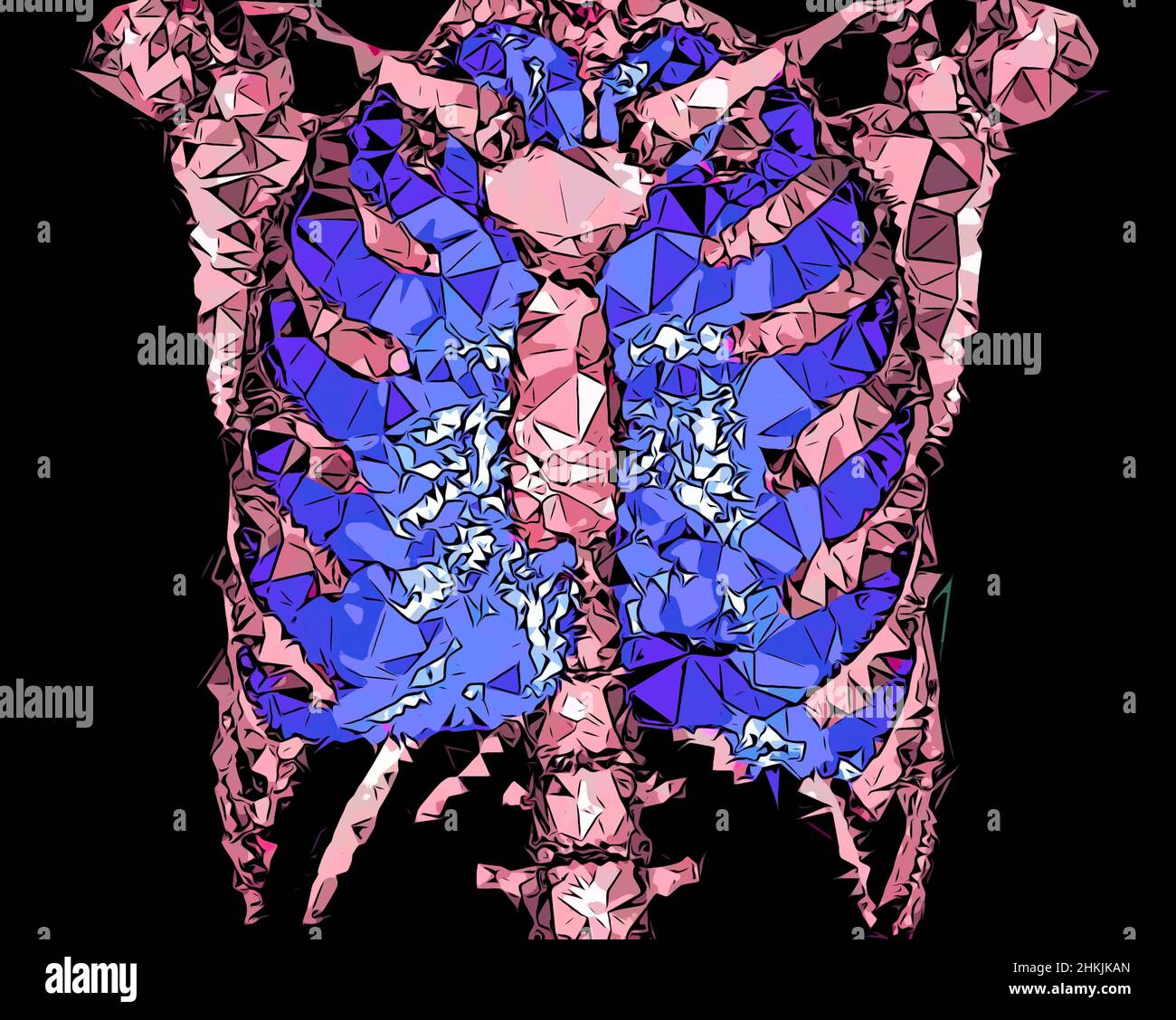 Lungs and ribs, CT scan Stock Photo - Alamy