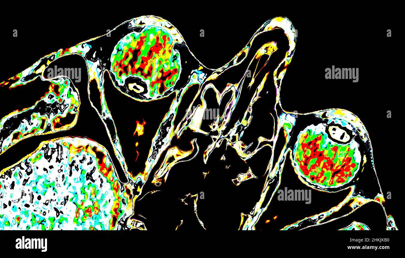 Traumatic detachment of the lens of the eye, CT scan Stock Photo - Alamy
