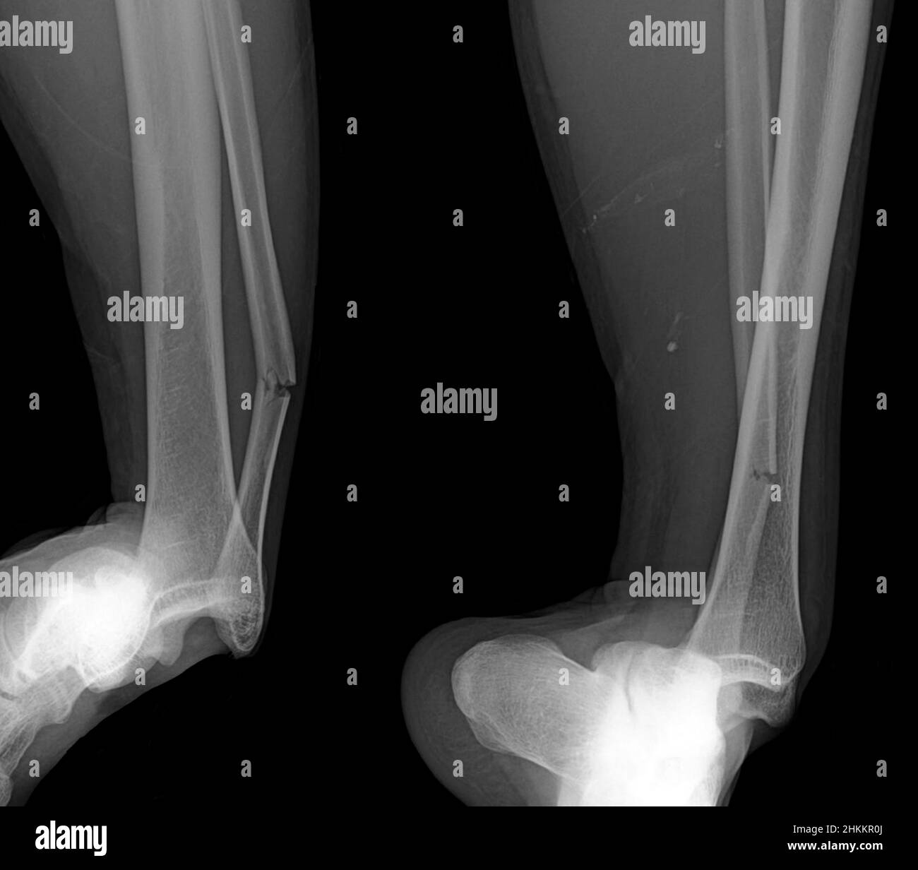 X Ray Ankle Dislocation Medworldonline