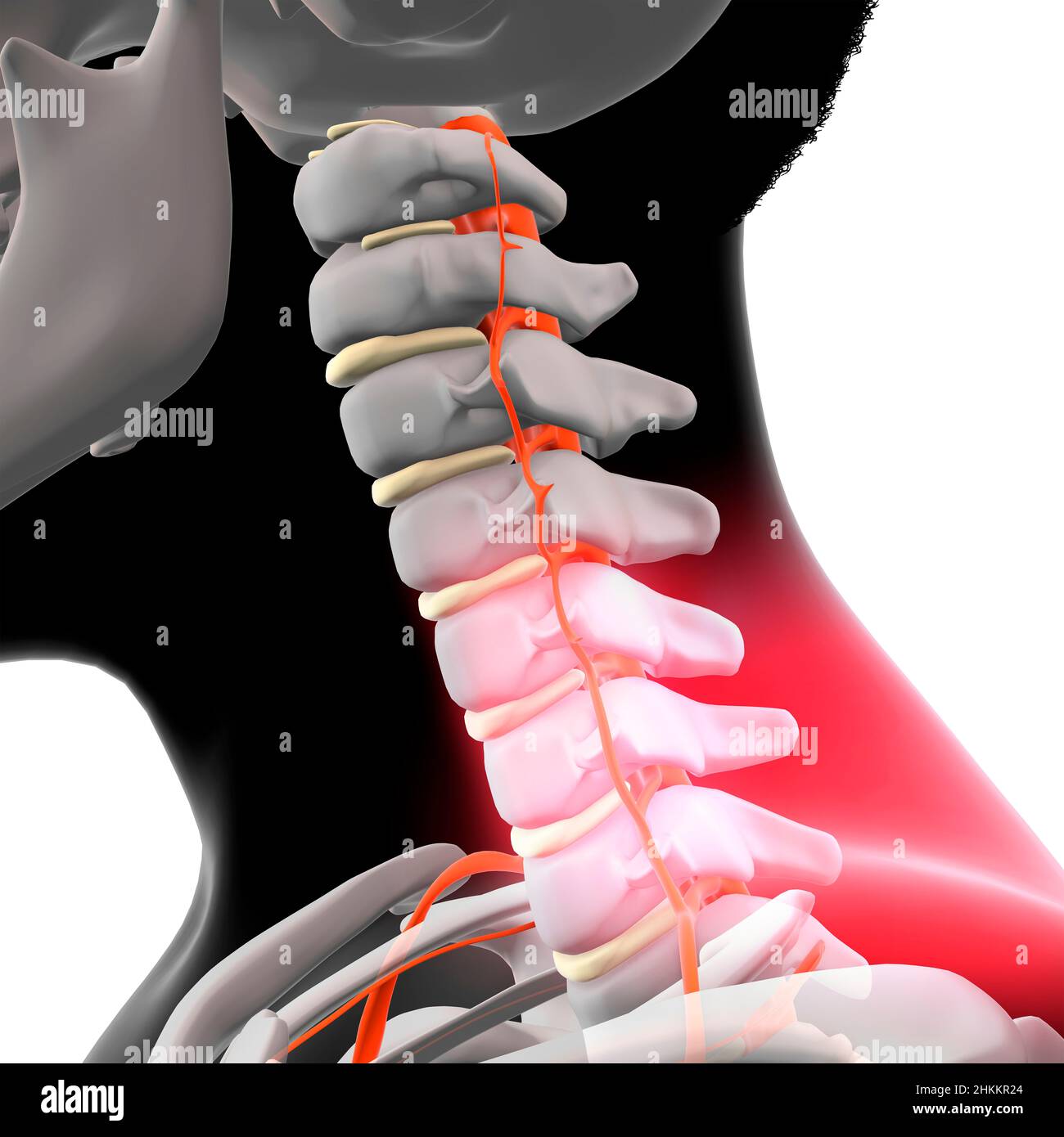 Slipped disc neck hi-res stock photography and images - Alamy
