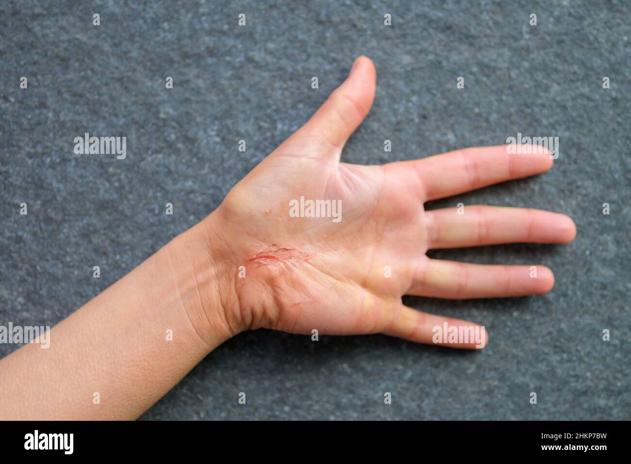 Palm hand wound hi-res stock photography and images - Alamy