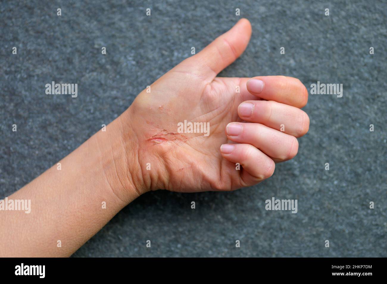 Close up of a injured hand with a bloody wound Stock Photo - Alamy