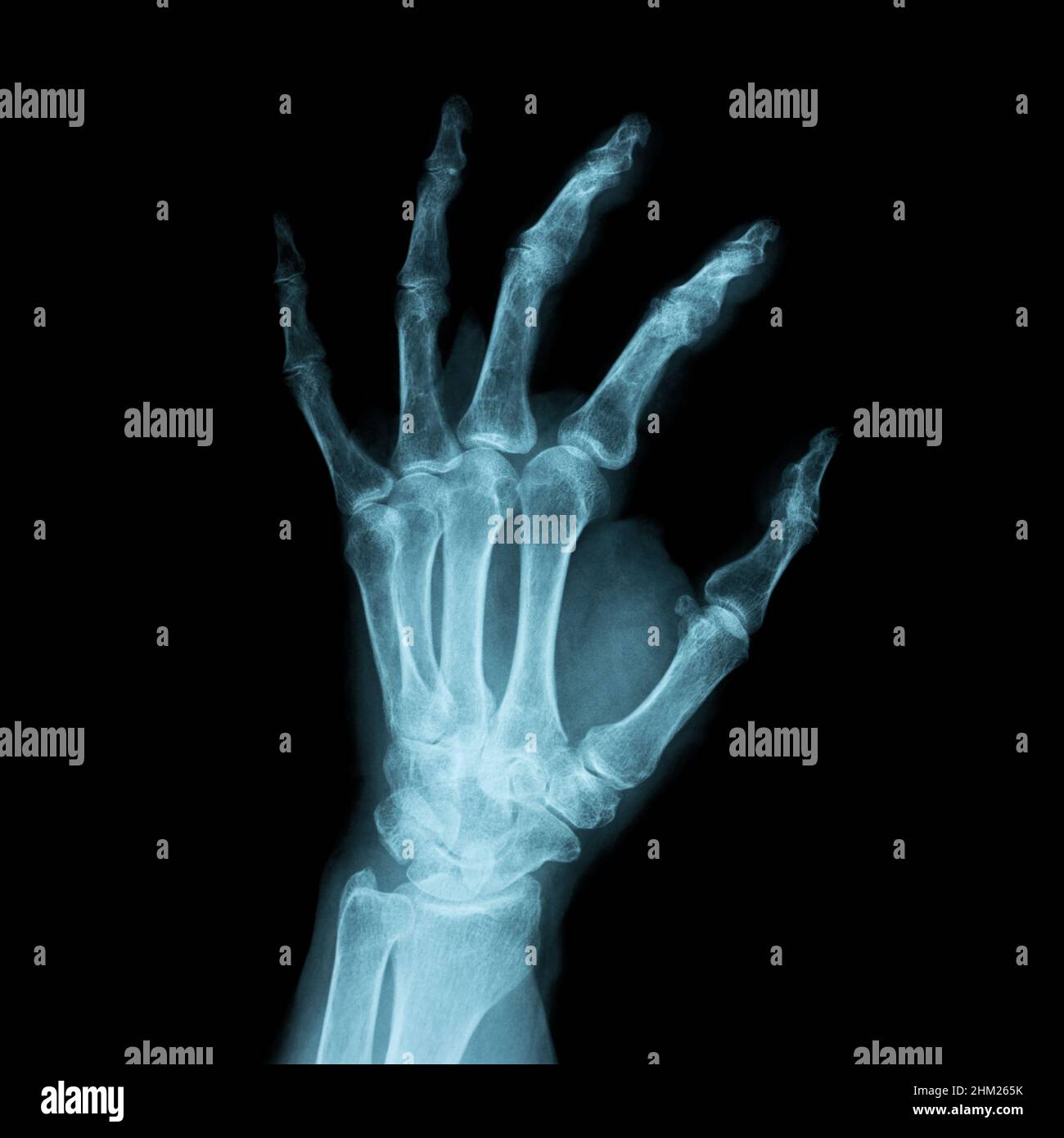 X ray human left hand hi-res stock photography and images - Alamy