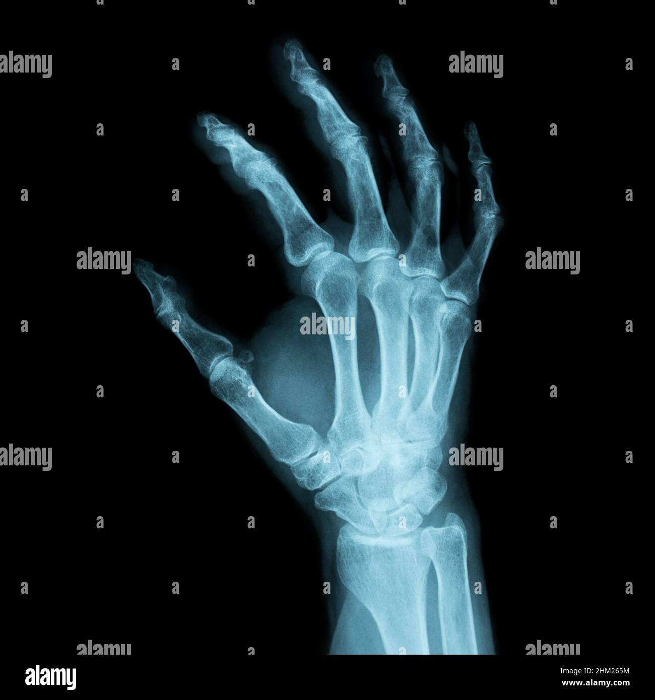 Medical x ray and thumb hi-res stock photography and images - Alamy