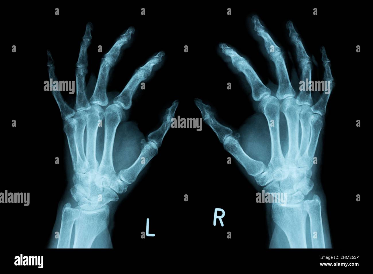 x-ray Image of both human hands Stock Photo - Alamy