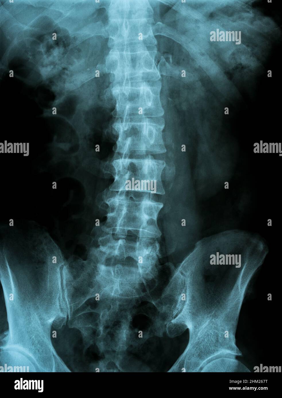 Spinal radiograph hi-res stock photography and images - Alamy