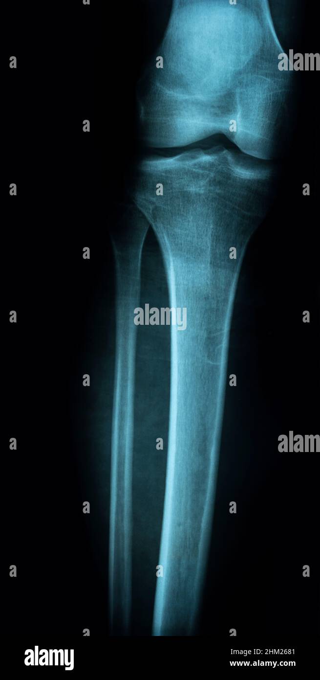 X-ray image of a leg for a medical diagnosis Stock Photo - Alamy