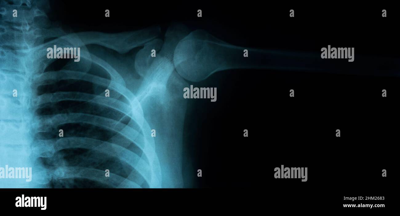 X-Ray Image of Healthy Chest Stock Photo - Alamy