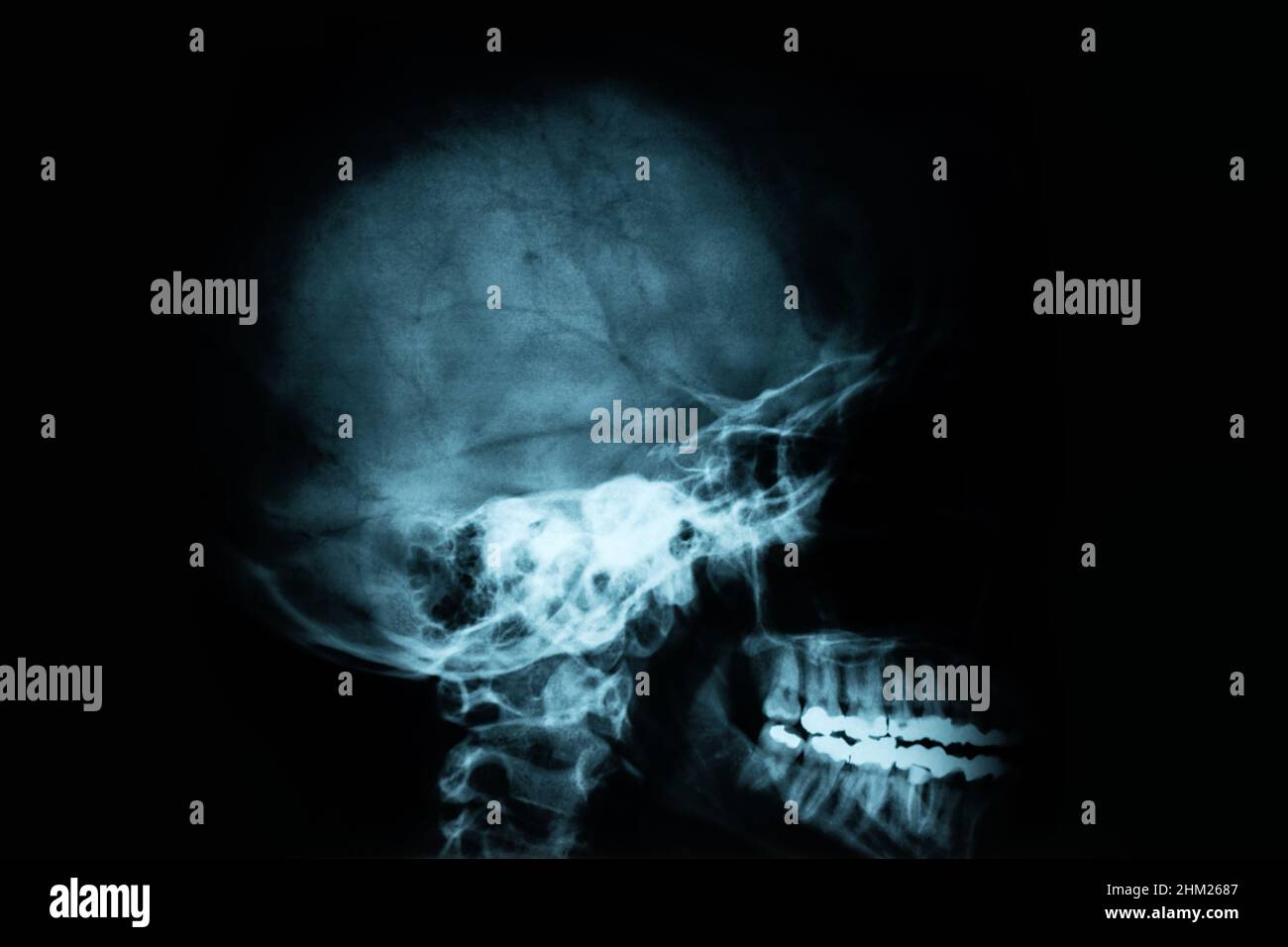 X-Ray Image of Healthy Chest Stock Photo - Alamy