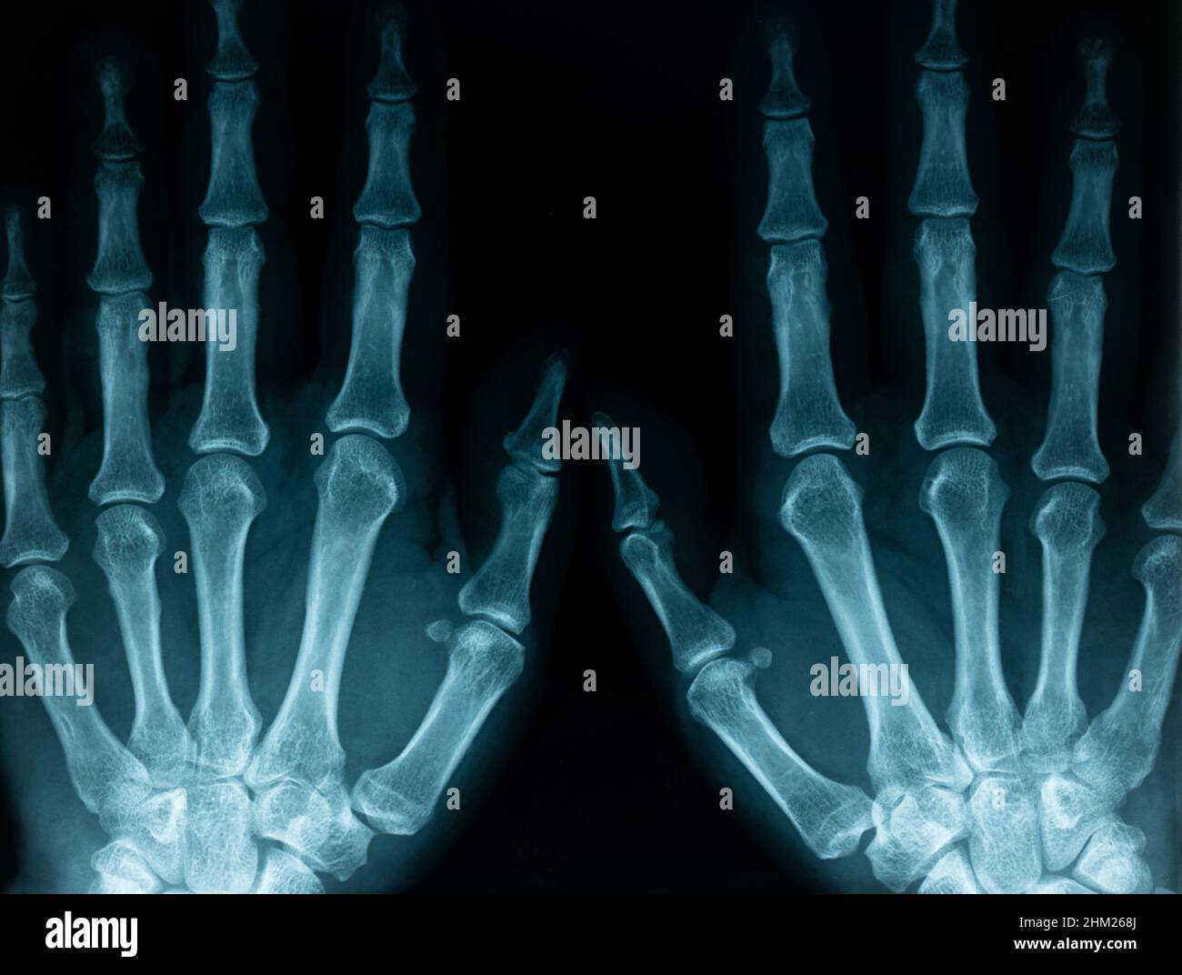 x-ray closeup of hands Stock Photo - Alamy