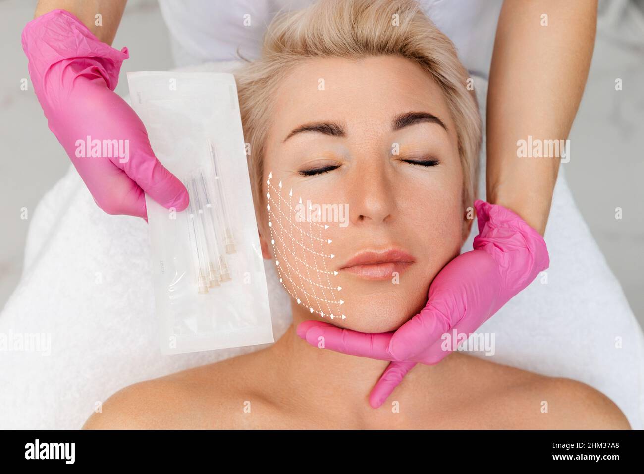 Woman's face with arrows on a cosmetology procedure of thread lifting ...