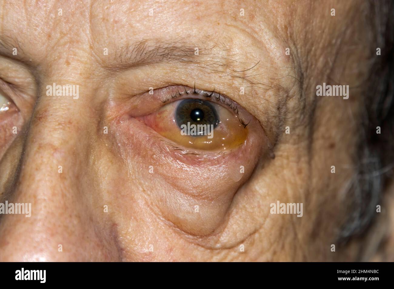 Elder man with conjunctivitis Stock Photo - Alamy