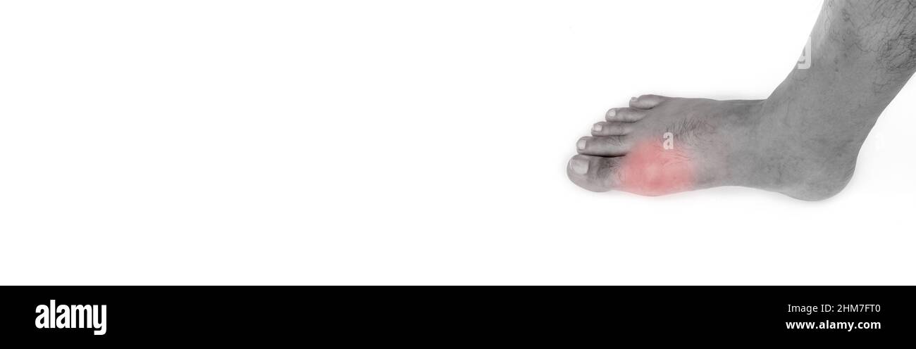 Foot disease Rheumatism and gout. Red leg swelling. Pain in the foot ...