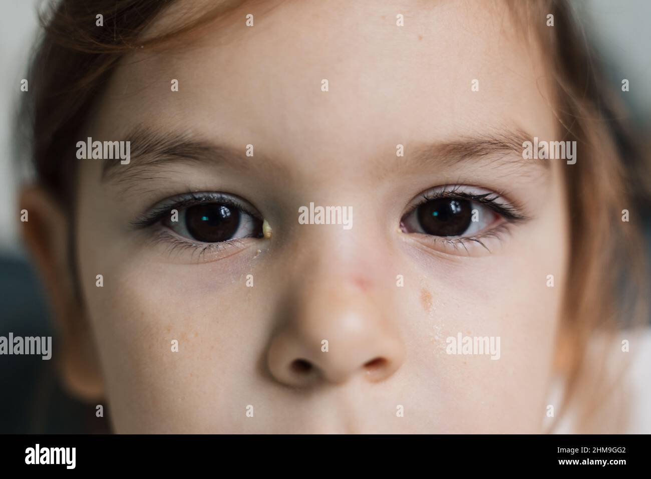 Conjunctivitis infant hi-res stock photography and images - Alamy