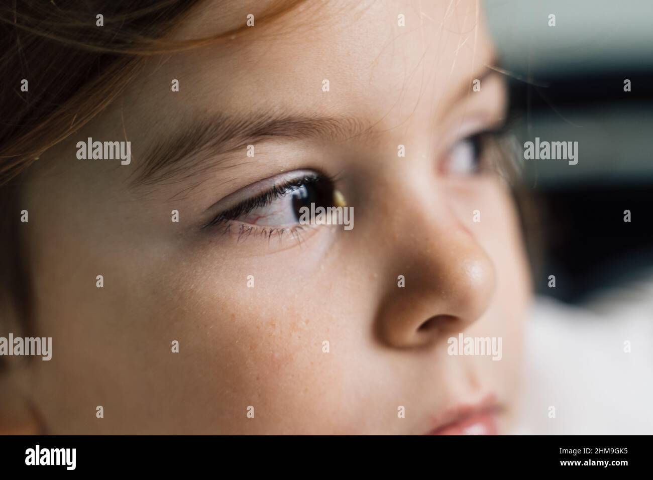 Close up of child ill with conjunctivitis, red eye with pus Stock Photo ...
