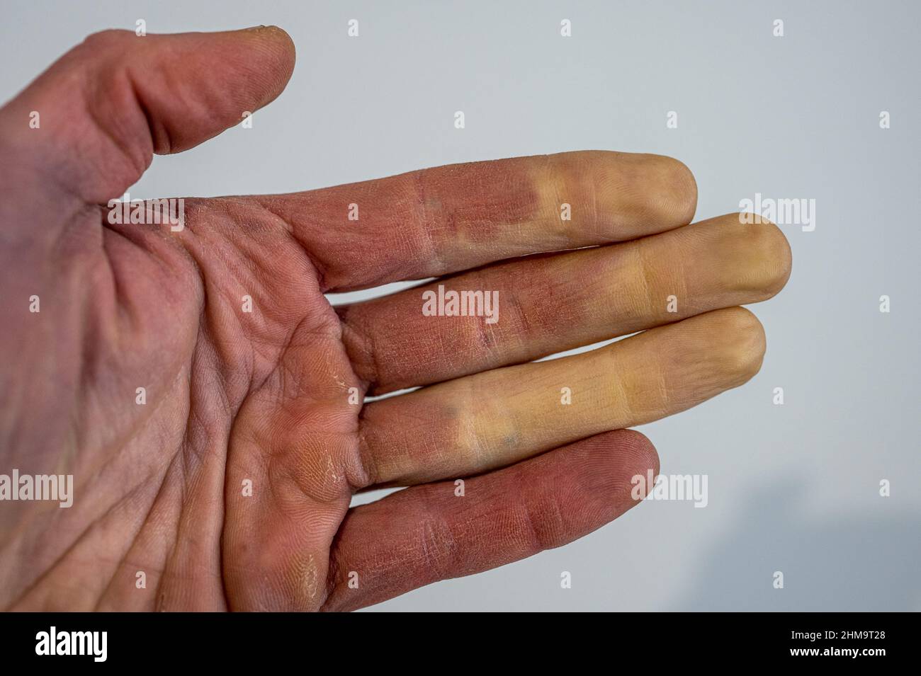 Male raynaud syndrome hand hi-res stock photography and images - Alamy