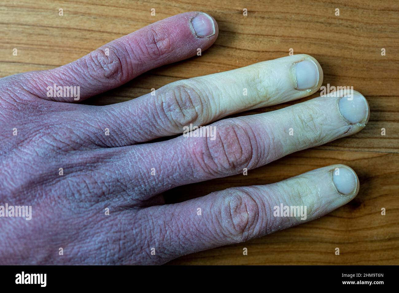 A frostbitten male hand with Raynaud's syndrome, Raynaud's phenomenon ...