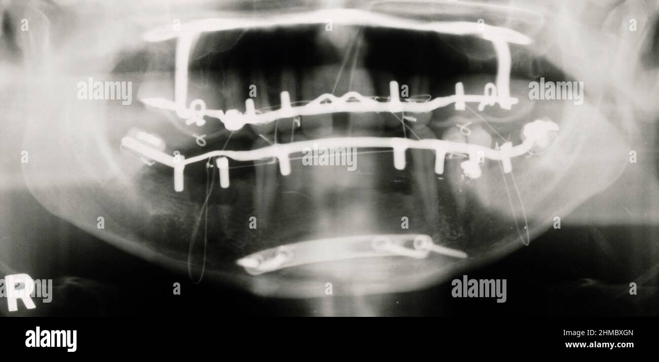Post-operative x-ray of jaw Stock Photo - Alamy