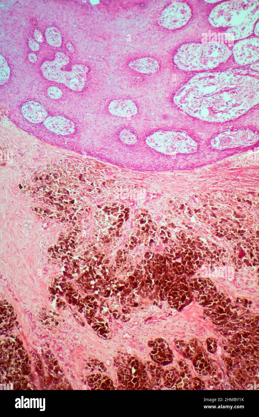 Malignant melanoma, LM Stock Photo - Alamy