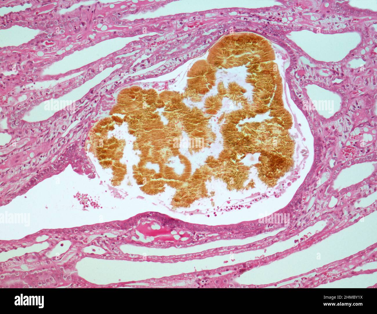 Urates in the kidney, LM Stock Photo - Alamy