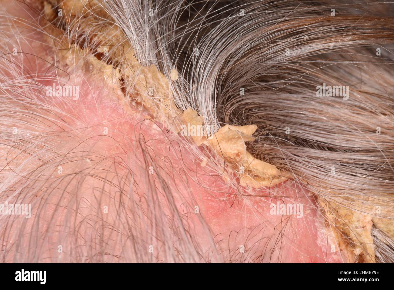 Erosive pustular dermatosis Stock Photo - Alamy
