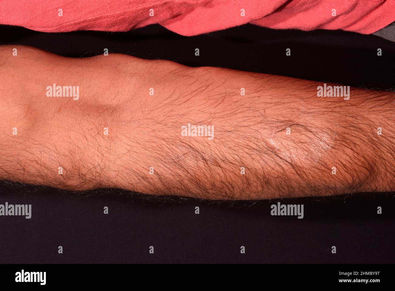 Multiple lipomas on arm Stock Photo - Alamy