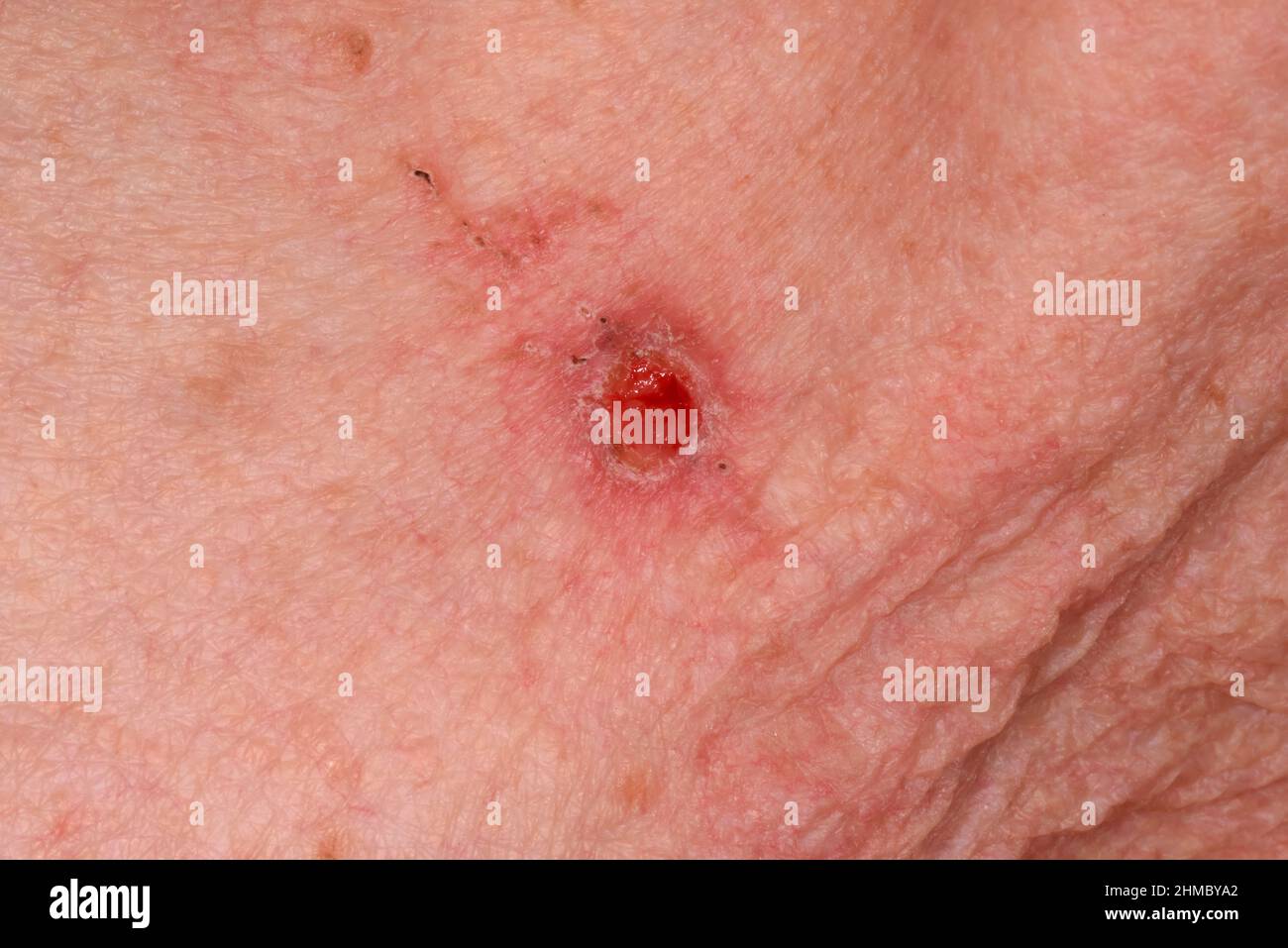 Basal cell carcinoma Stock Photo - Alamy