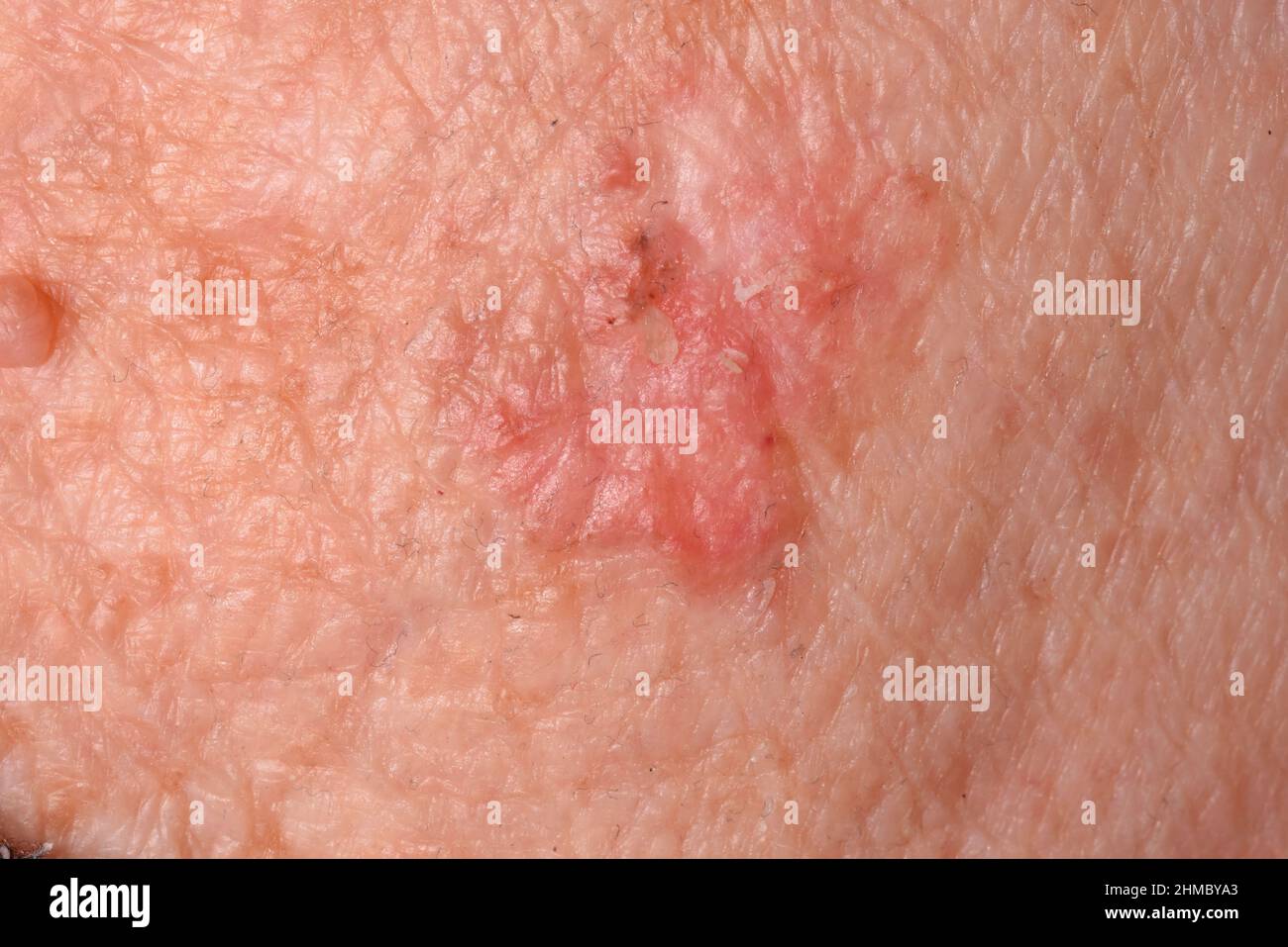 Basal cell skin cancer on the chest Stock Photo - Alamy