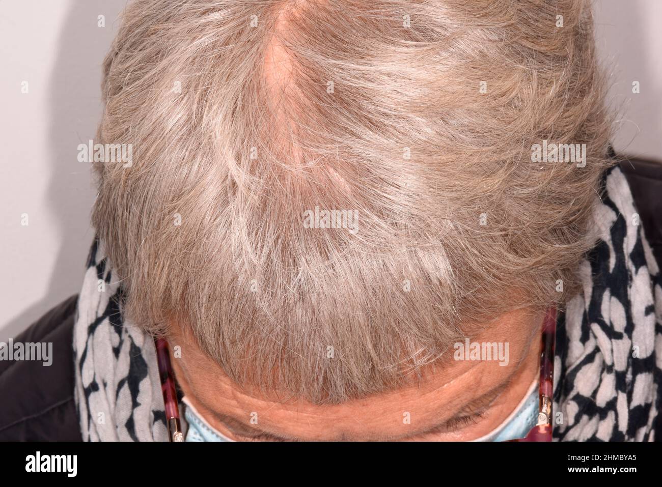 Hair regrowth in a patient with alopecia Stock Photo - Alamy