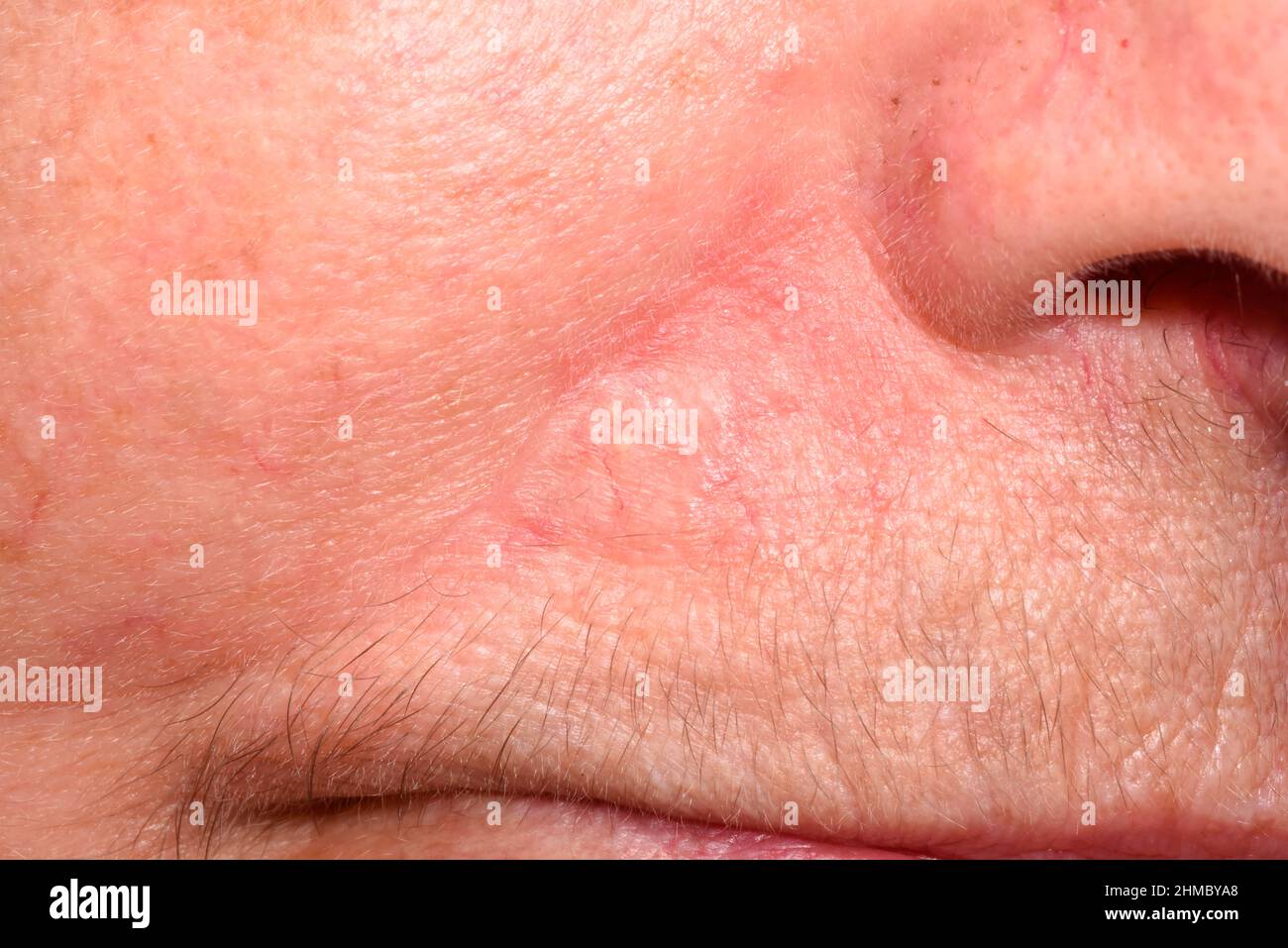 Basal cell carcinoma Stock Photo - Alamy
