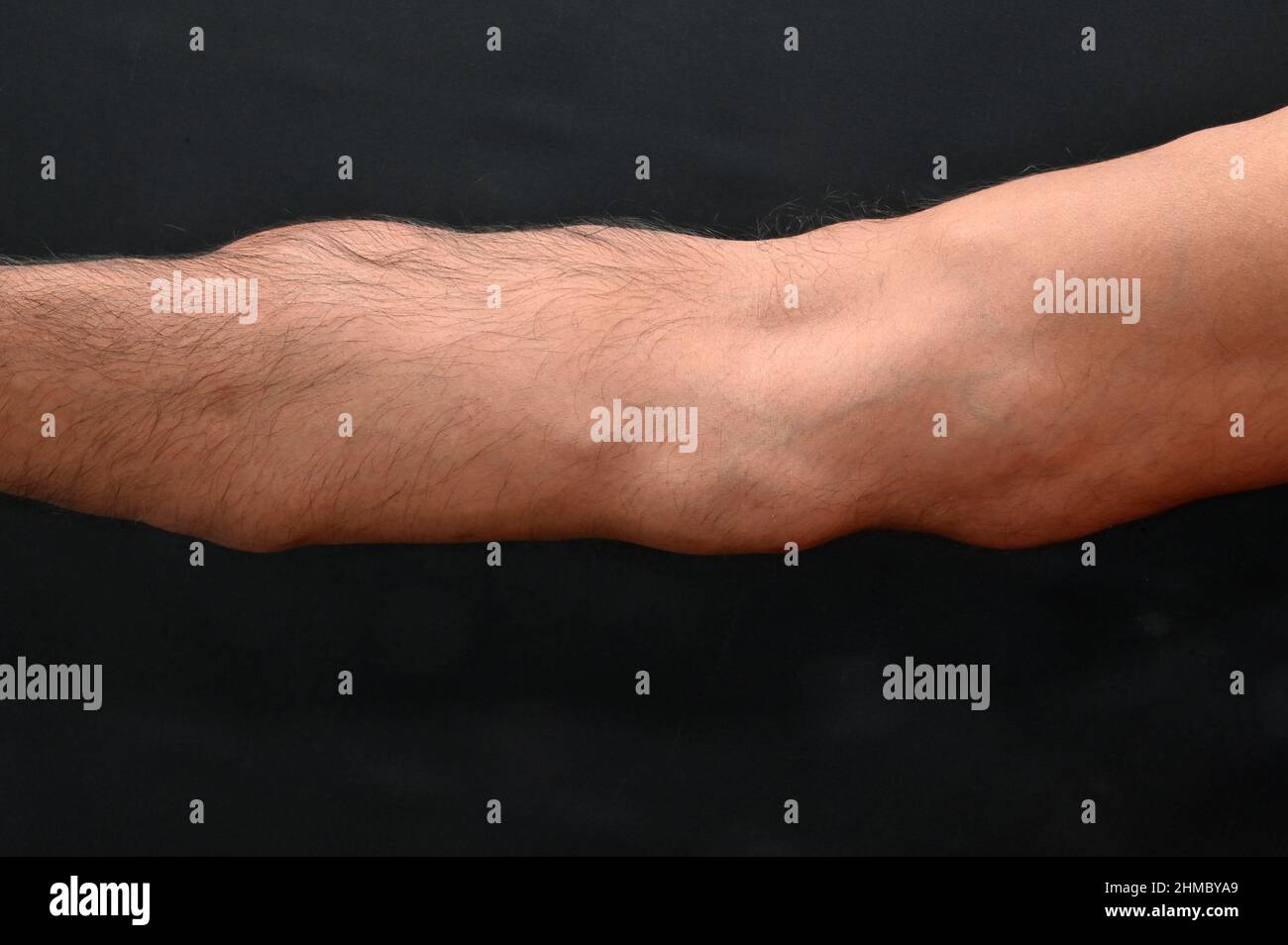 Multiple lipomas on arm Stock Photo - Alamy