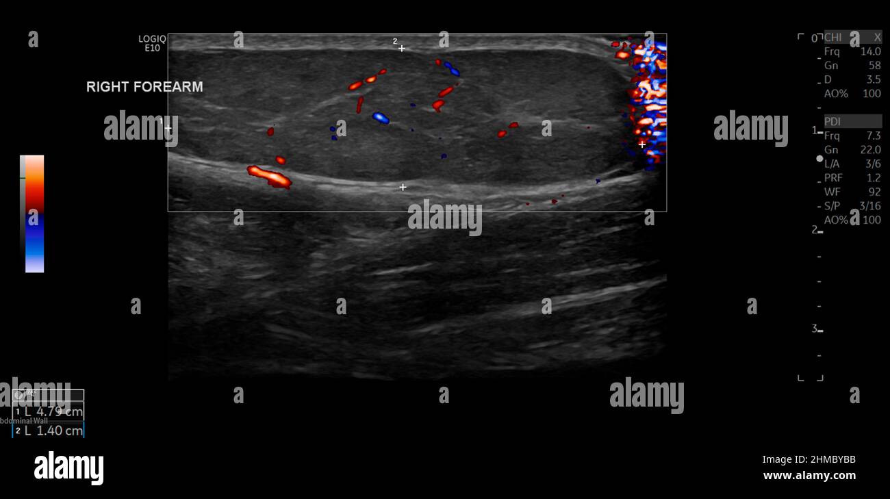 Multiple lipomas, ultrasound scan Stock Photo - Alamy