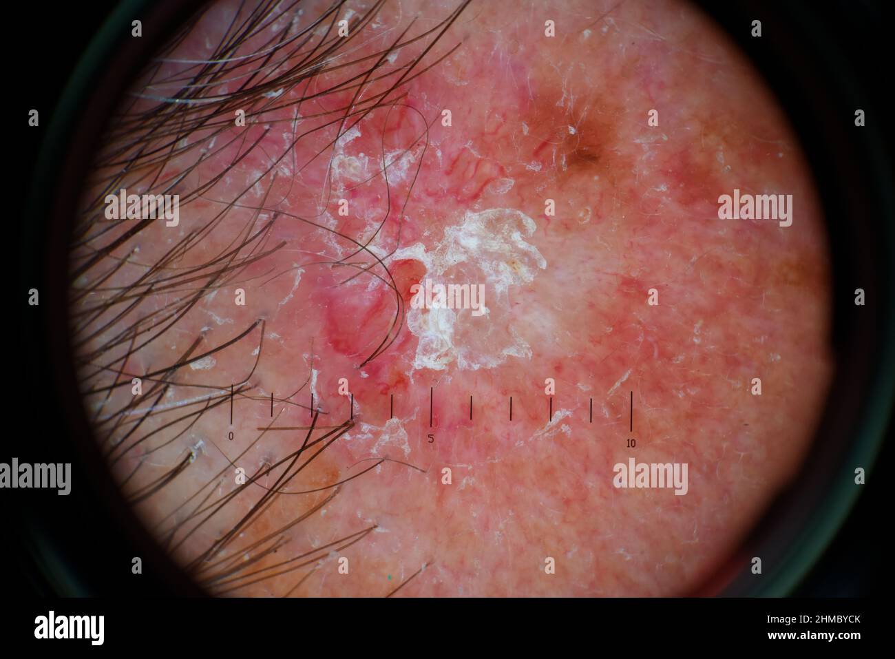 Basal cell carcinoma, dermascope image Stock Photo - Alamy
