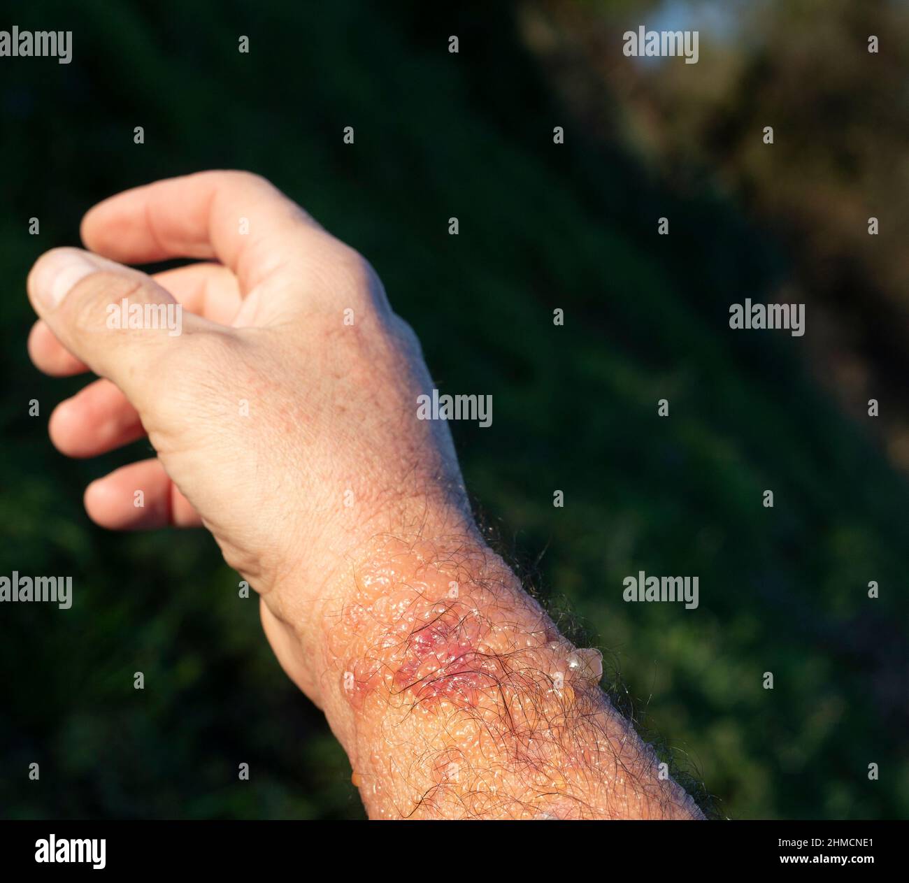 A blistered forearm badly affected by phytophotodermatitis Stock Photo ...