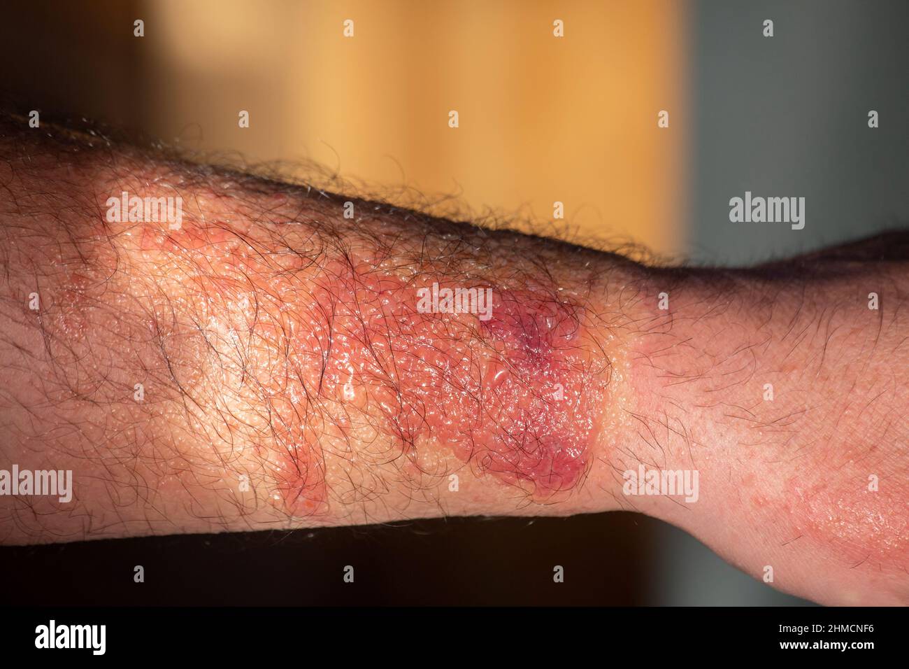 A blistering of the forearm due to a phytophotodermatitis reaction ...