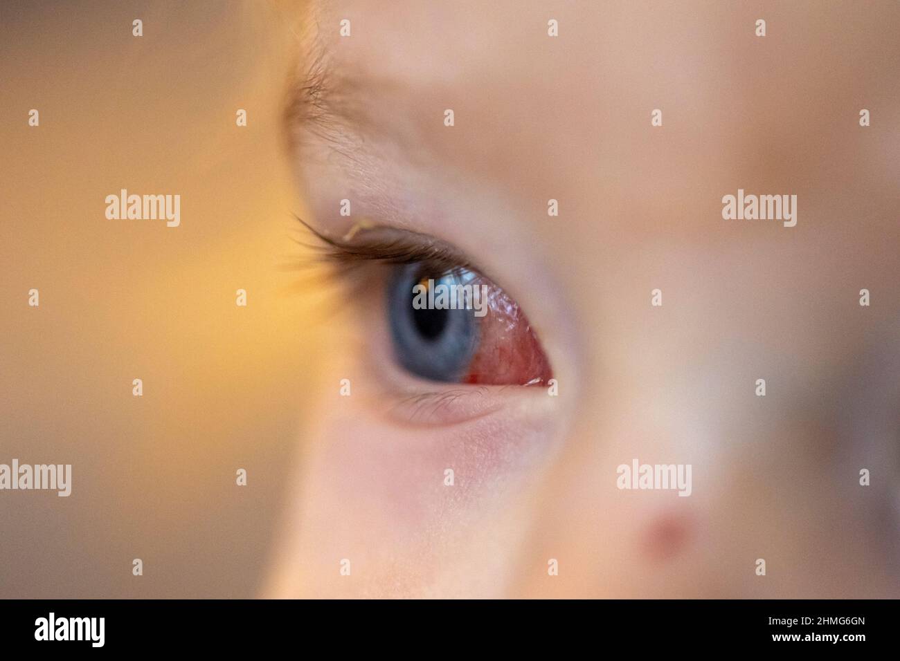 A close portrait of an infected red eye of a child with conjunctivitis ...