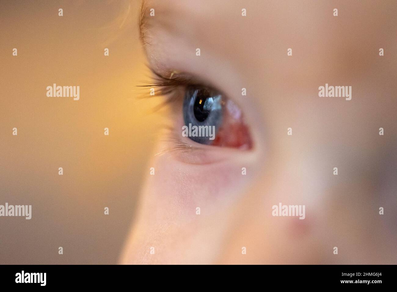 A portrait of an infected red eye of a child with conjunctivitis. The ...
