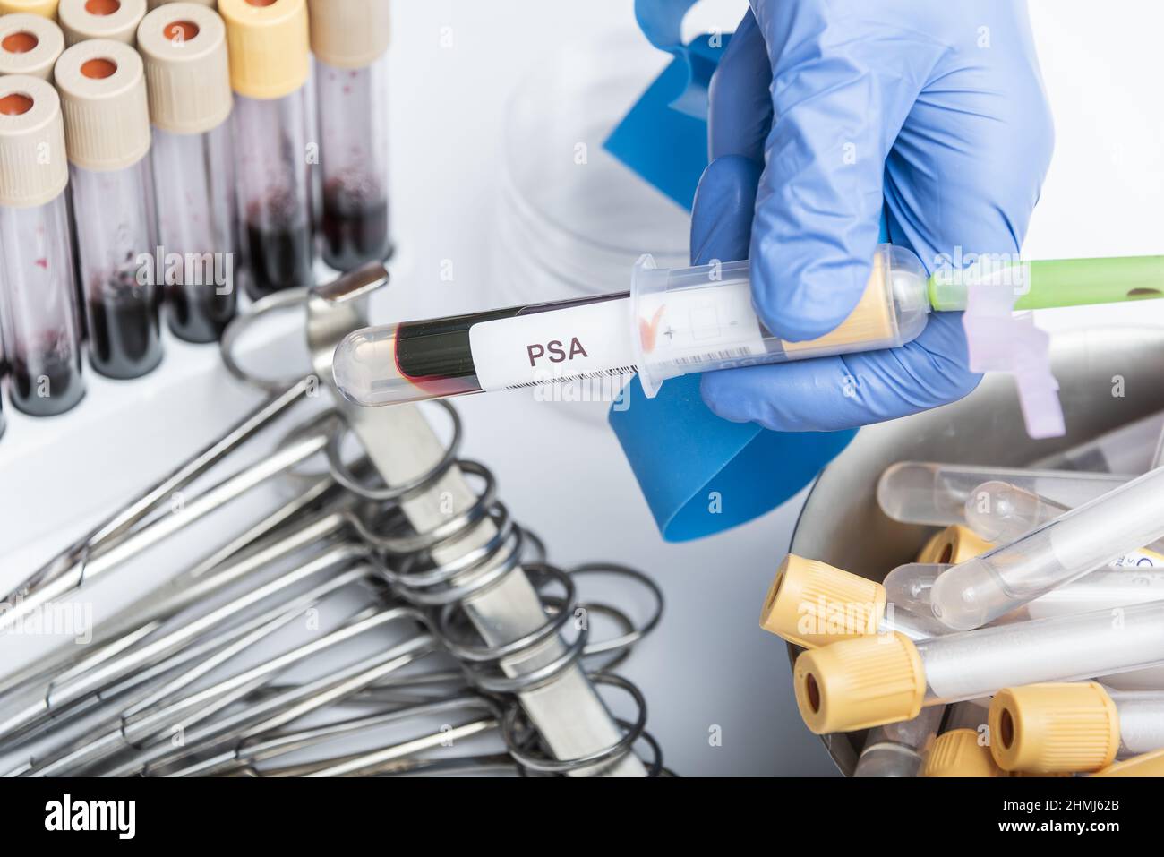 Blood sample positive with PSA Prostate-specific antigen test Stock ...