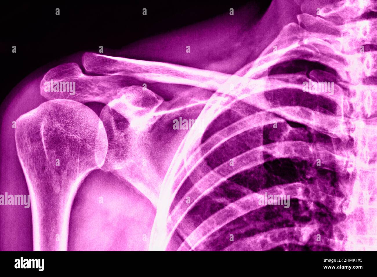 Shoulder x ray image hi-res stock photography and images - Alamy