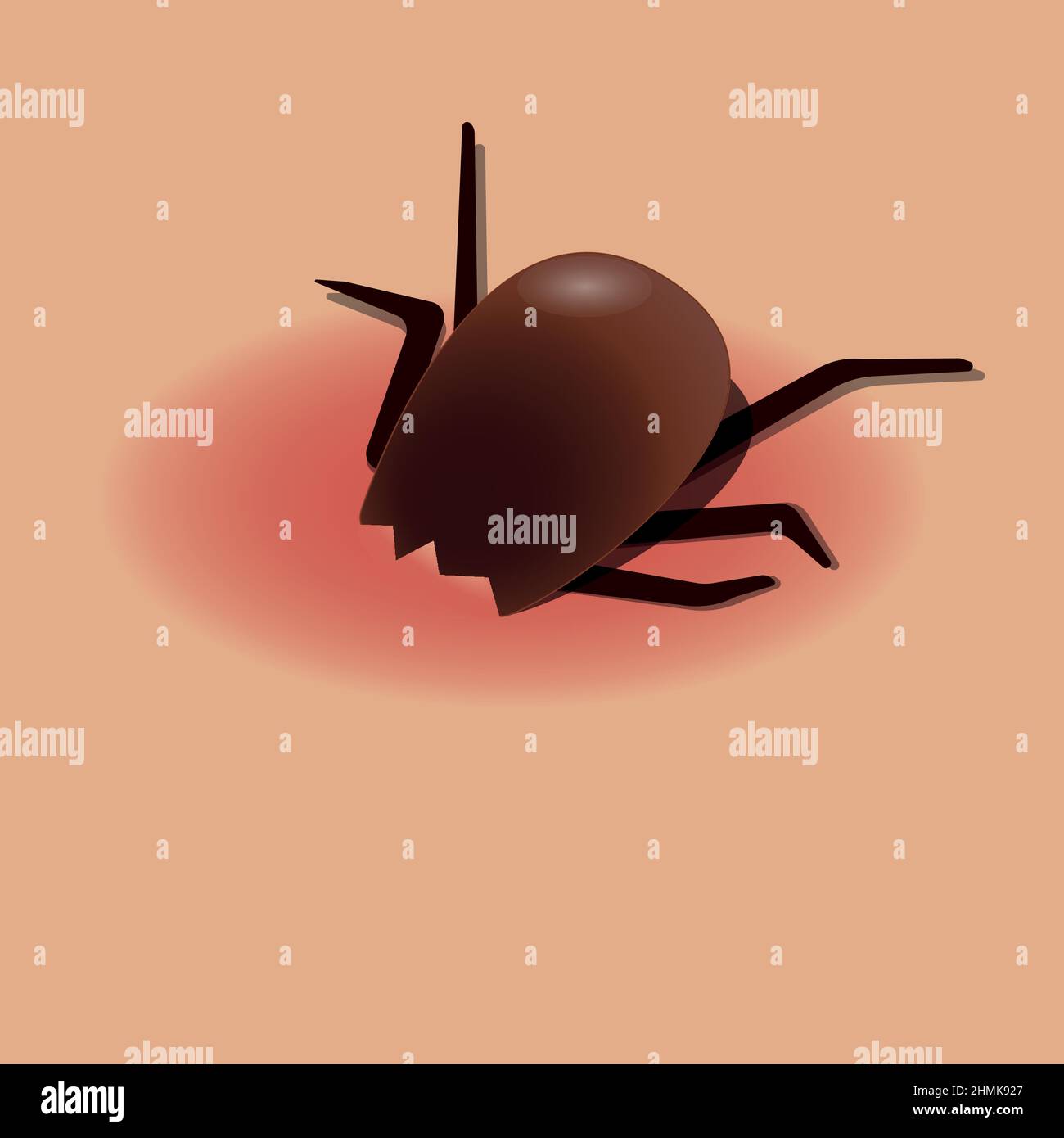 Tick biting through human skin, close up vector illustration Stock ...