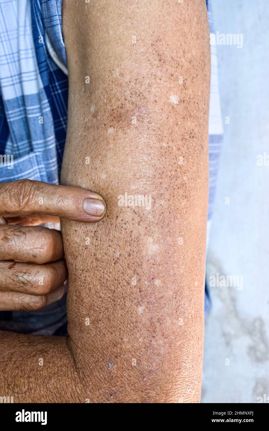 Hypopigmentation On Arms