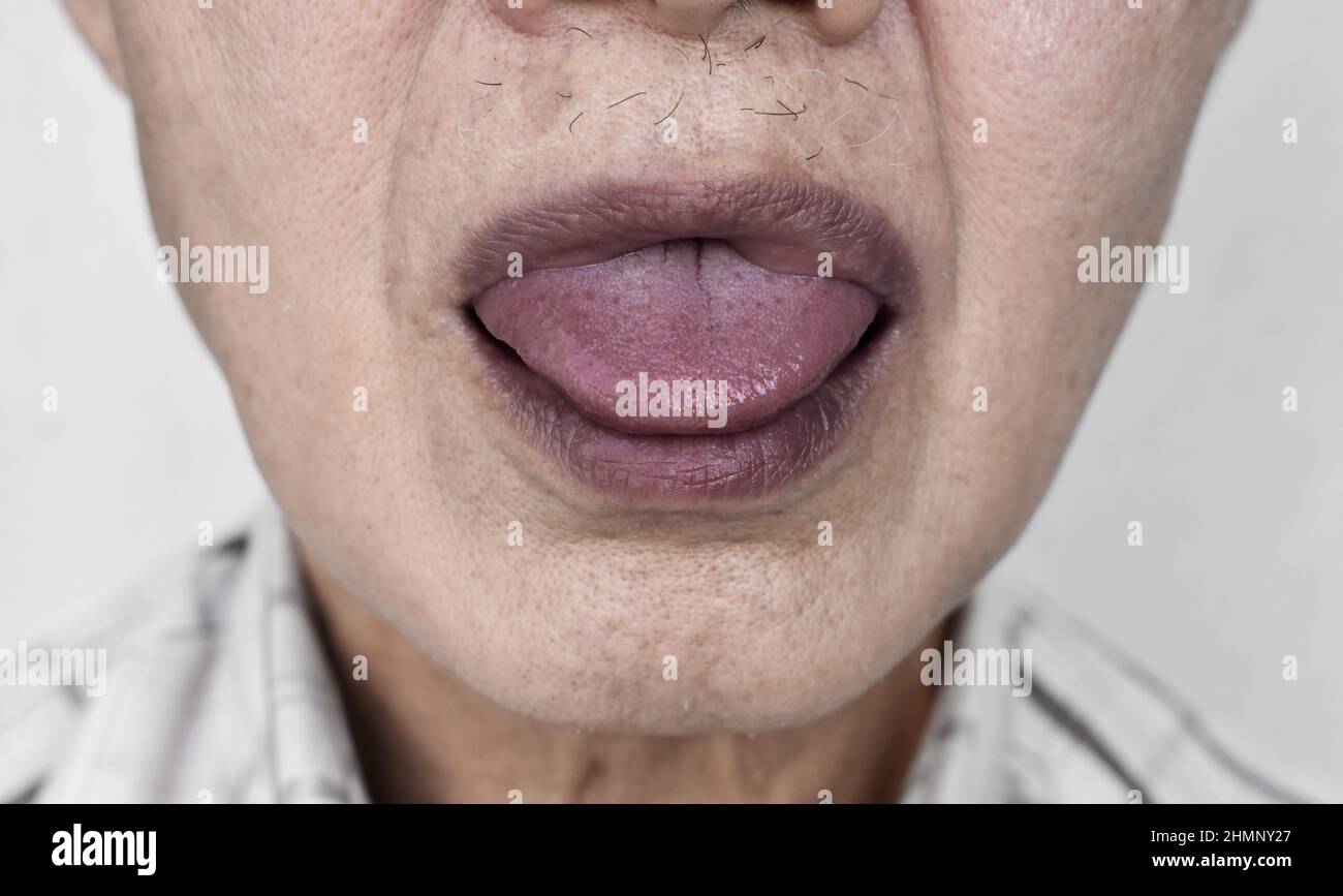 Cyanotic lips or central cyanosis at Southeast Asian elder man with ...