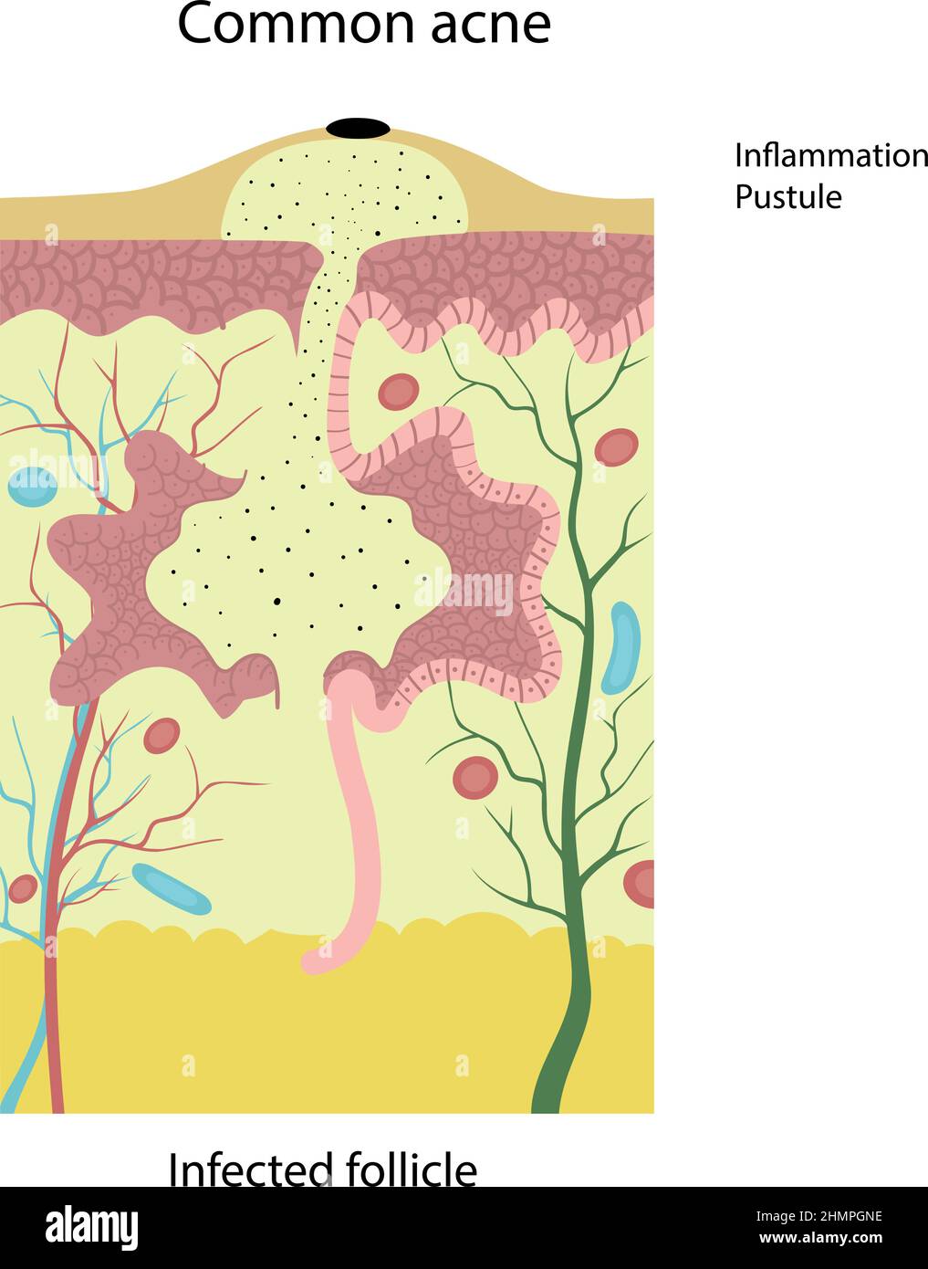 Vector illustration of acne. Infected follicle. Skin diseases Stock ...