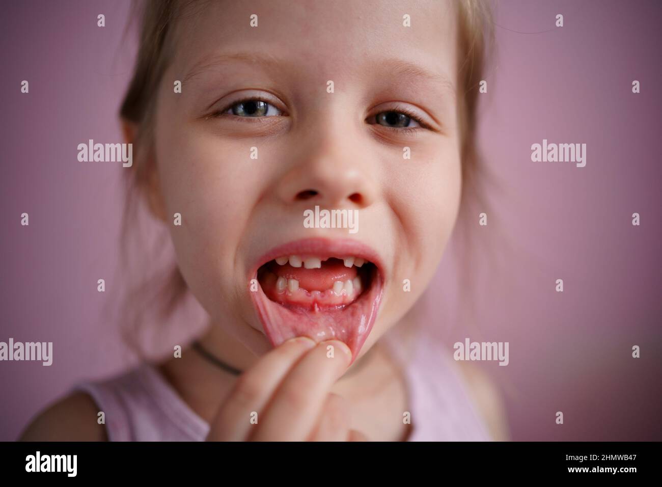 girl smiles without a front tooth Stock Photo - Alamy