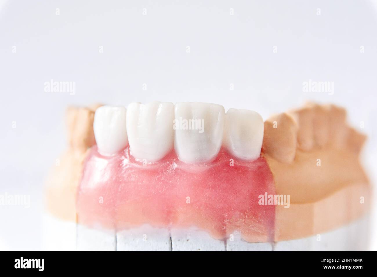 Denture made of ceramics located on plaster model Stock Photo - Alamy