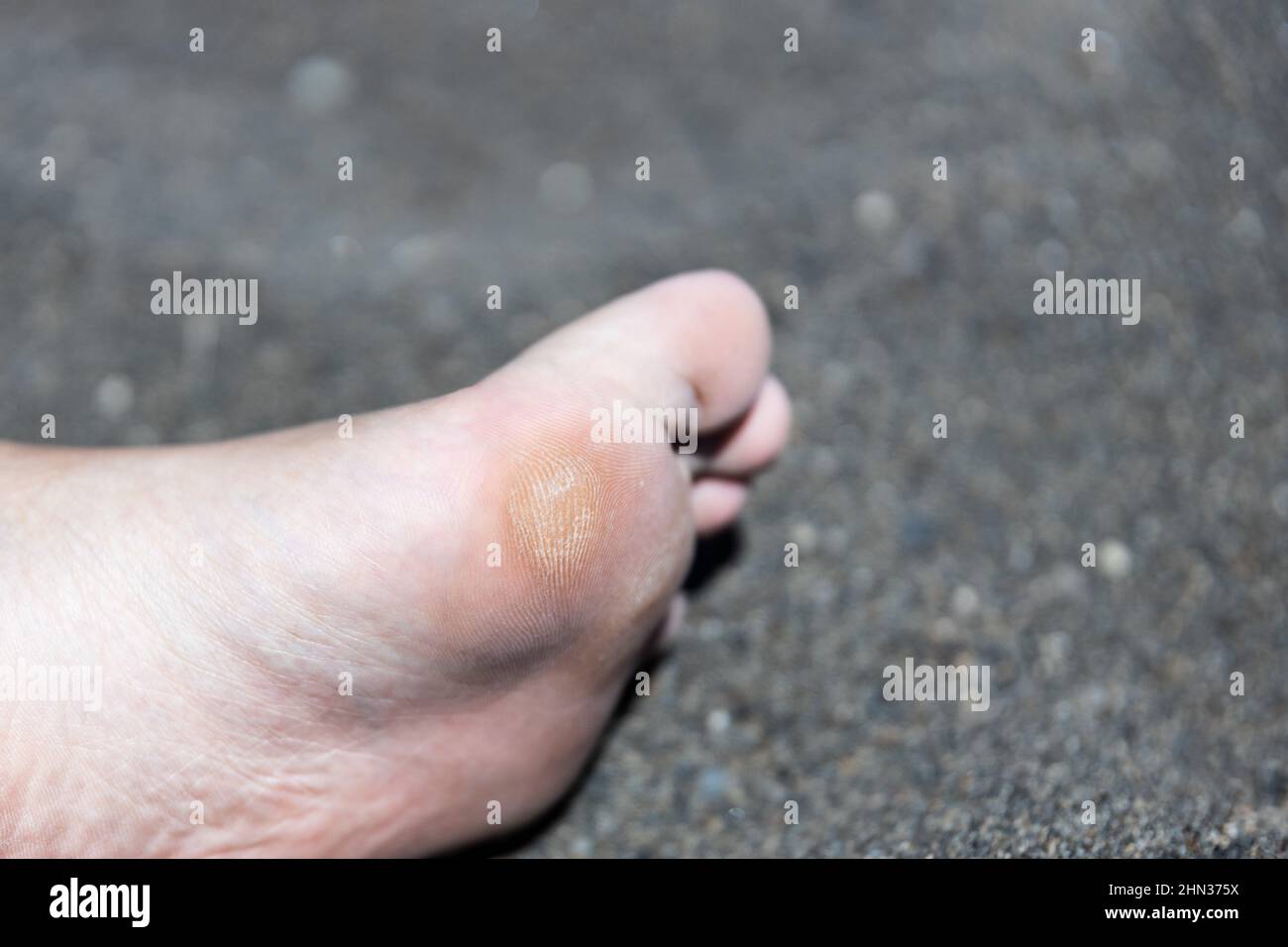 Callus heel hi-res stock photography and images - Alamy